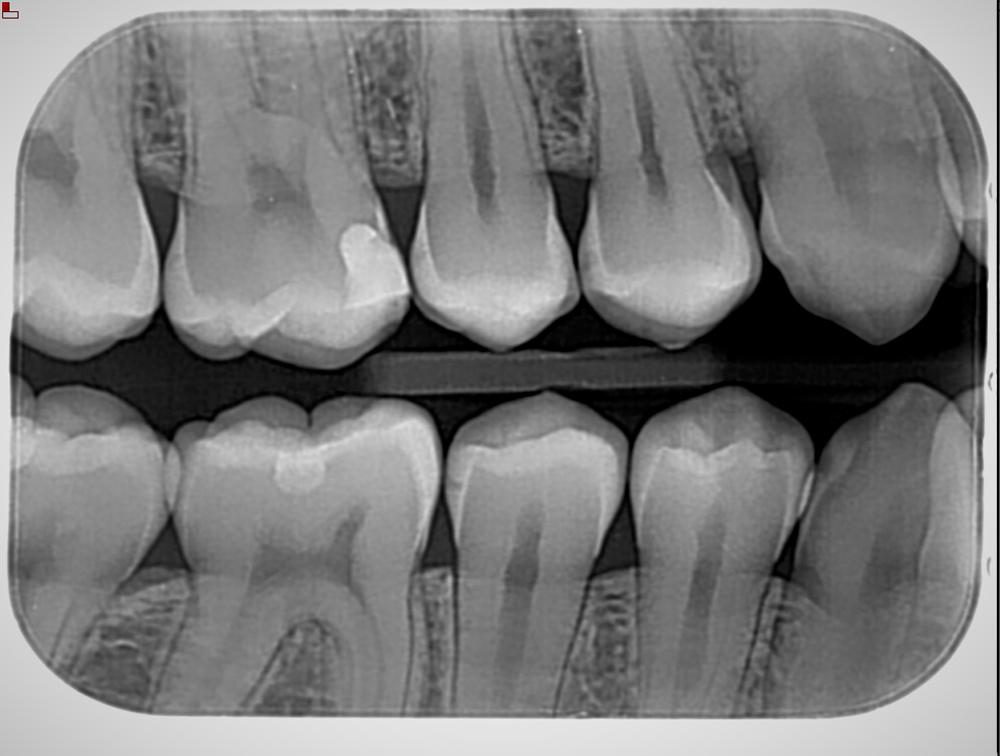 Bitewing X Ray Cancer at Georgina Crosby blog